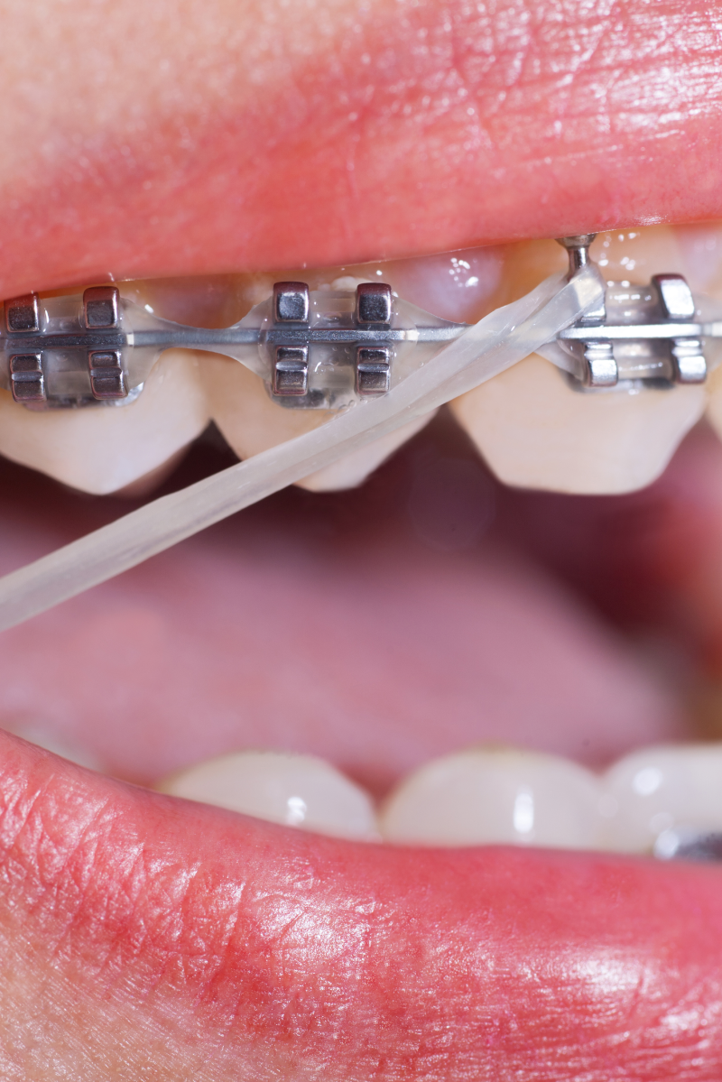 The Ultimate Guide to Orthodontic Treatment - The Braces Guide