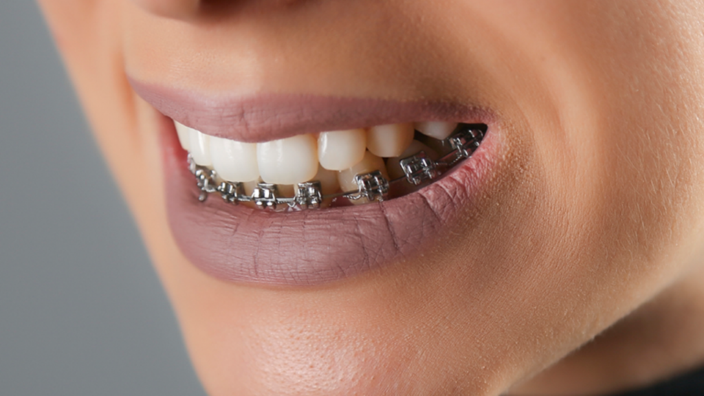 Getting Braces a Second Time: Everything You Need to Know - The Braces ...