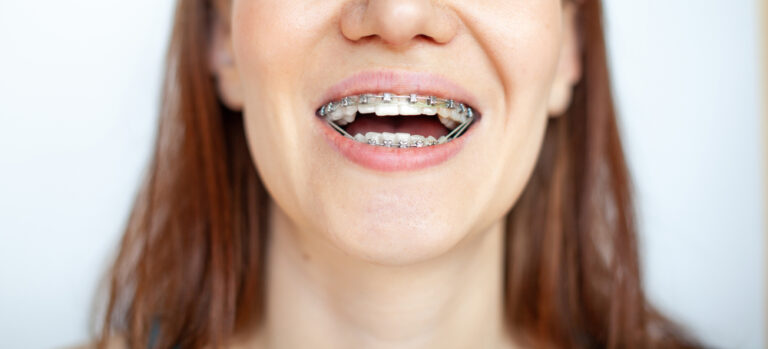 Braces Rubber Bands (Elastics): Everything You Need to Know - The ...