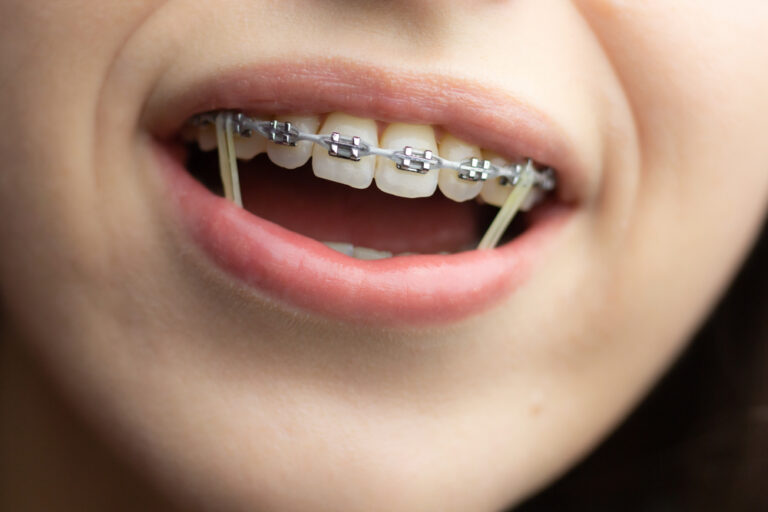 Braces Rubber Bands (Elastics): Everything You Need to Know - The ...