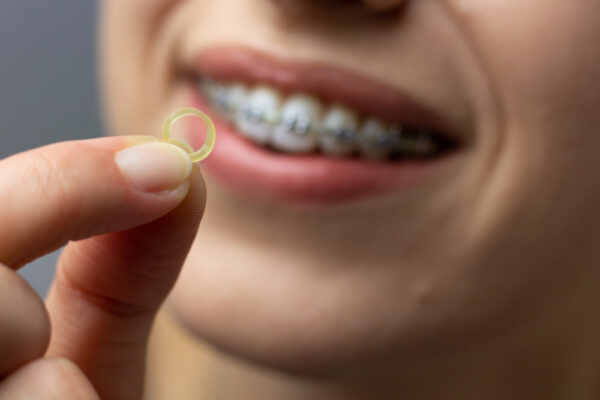 Braces Rubber Bands (Elastics): Everything You Need to Know - The ...