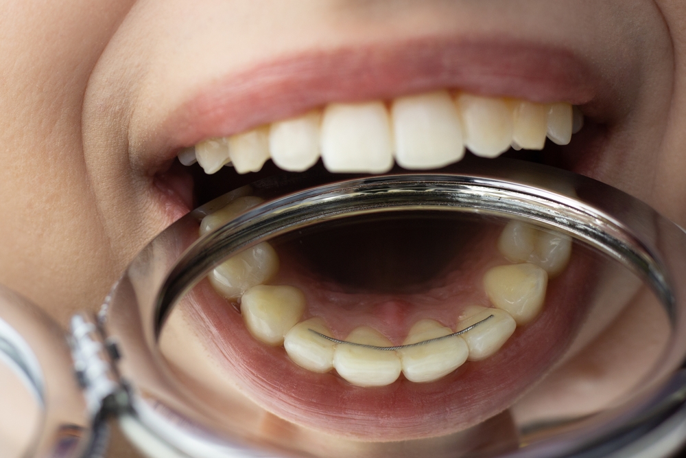 The Different Types of Retainers: Everything You Need to Know - The ...