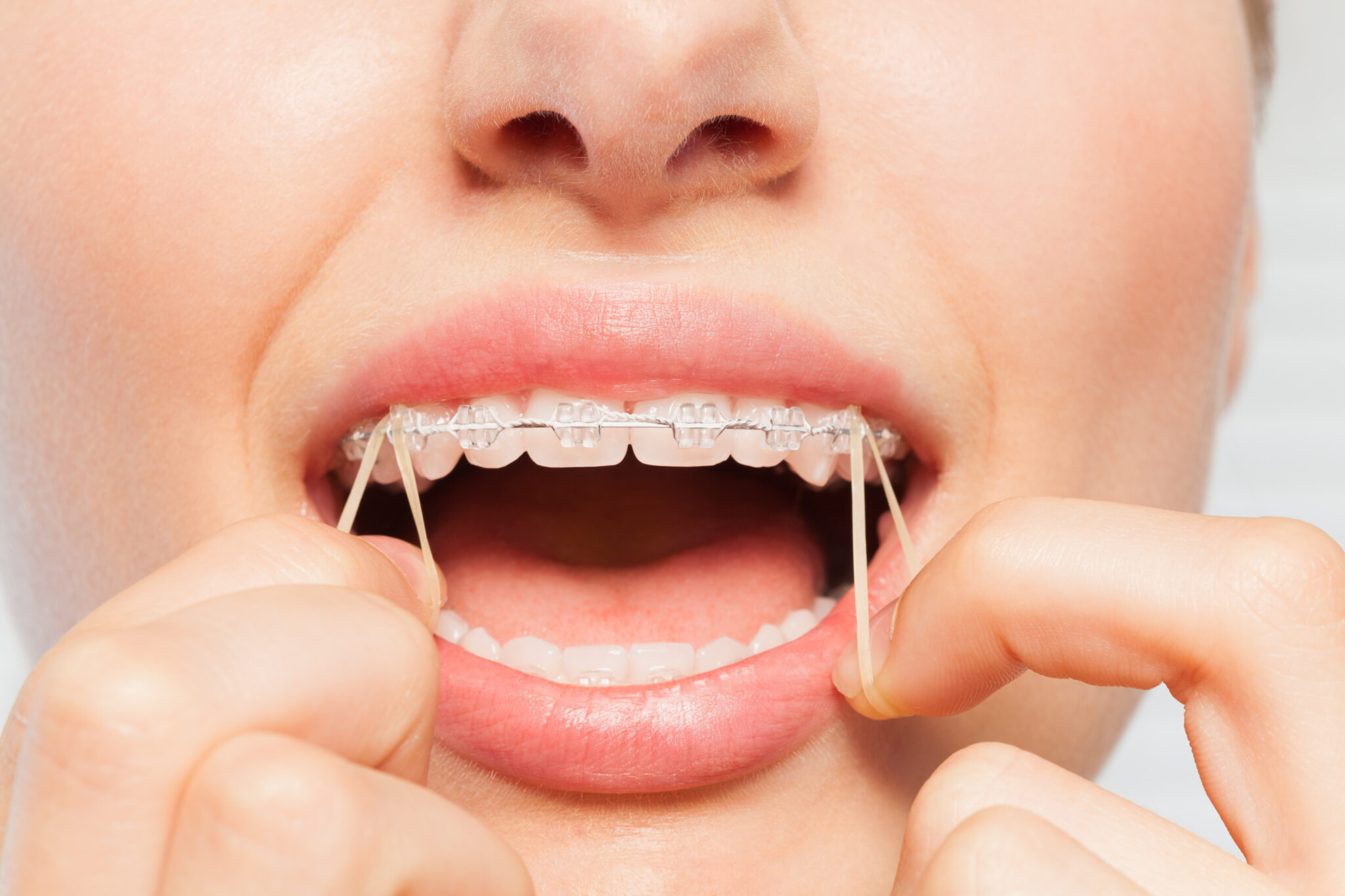 Braces Rubber Bands (Elastics): Everything You Need to Know - The ...