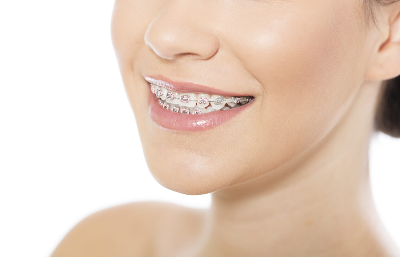 Is Pink a Good Color for Braces? - The Braces Guide