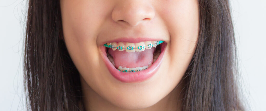 Is Green a Good Color for Braces? - The Braces Guide