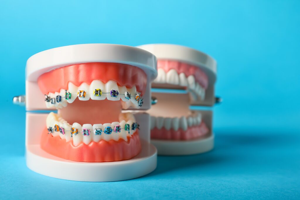 Is Rainbow a Good Color for Braces? Exploring Your Options - The Braces ...