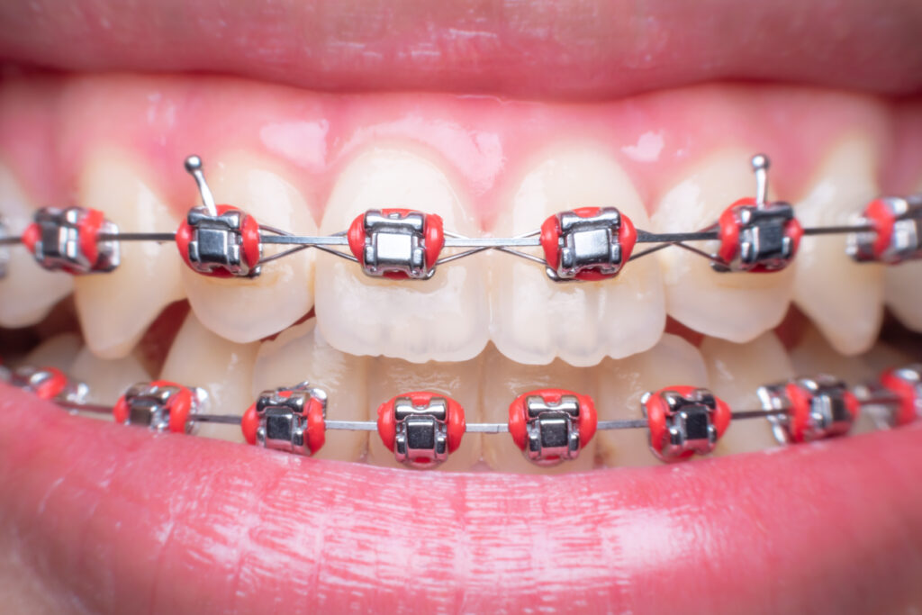 Is Red a Good Color for Braces? A Quick Guide - The Braces Guide