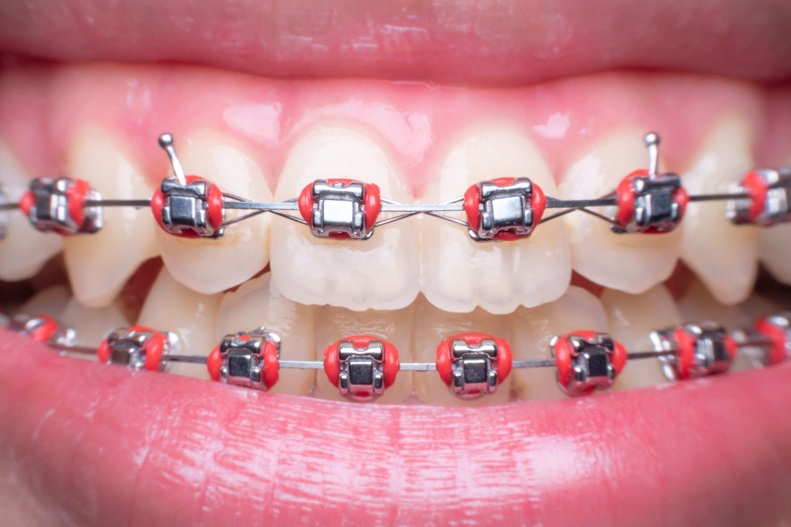 Red Colored Braces